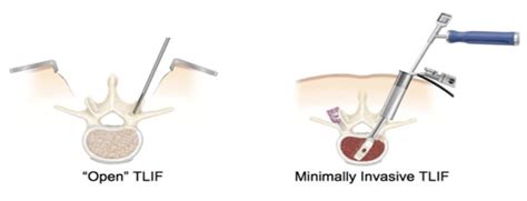 Minimally Invasive Surgical Mis Tlif Dr Paul Jeffords Md