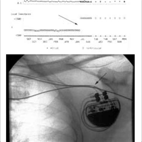 Pacemaker Syndrome Due To Pacing Mode Change At Pacemaker Battery Download Scientific Diagram