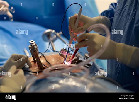Doctors Performing Spine Surgery Using Neuronavigation Computer
