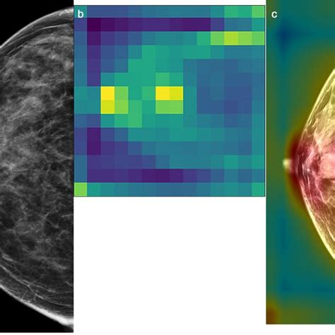 Class Activation Heatmap For A Malignant Lesion A Input Mammographic