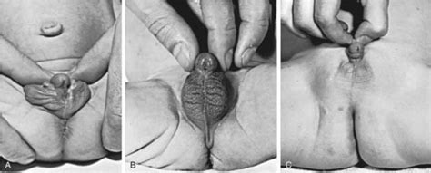 Congenital Adrenal Hyperplasia And Related Disorders Obgyn Key