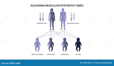Duchenne Muscular Dystrophy Stock Vector Illustration Of Offspring