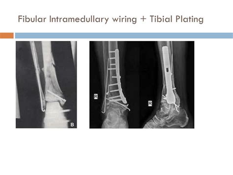 Ppt Fibular Fixation In Pilon F Racture Powerpoint Presentation Free Download Id 2176483