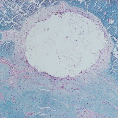 Six weeks after combination of β TCP and Platelet Rich Plasma