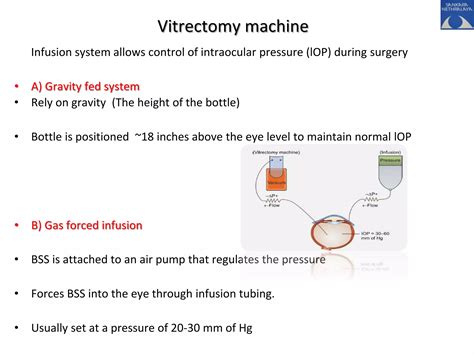 Vitrectomy Development And Steps Pptx