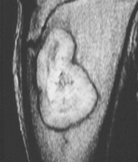 Fibroma Condromixoide