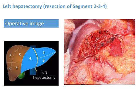 Anatomical Liver Resection Pptx