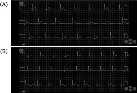 Figure4 Electrocardiographic Monitoring At Rest And During Exertion Download Scientific
