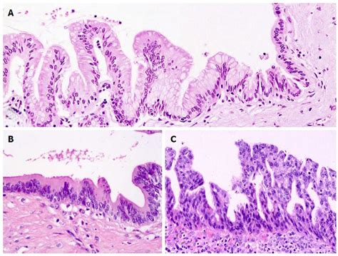 Pathological features and diagnosis of intraductal papillary mucinous ...