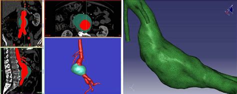 a image based segmentation of the ct data and the resulted 3d