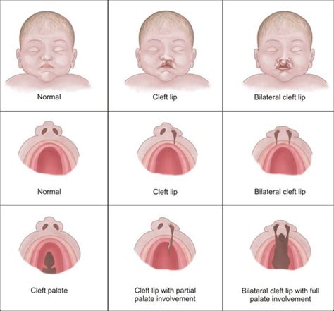 Cleft Lip And Cleft Palate Cleft Lip And Palate Links