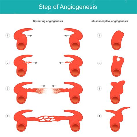 The Role Of Eecp In Promoting Angiogenesis For Heart Disease Treatment