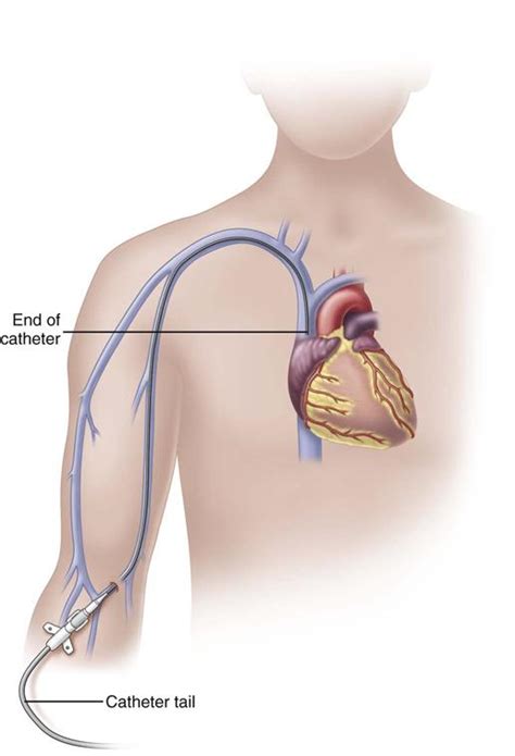 Infusion Therapy Nurse Key