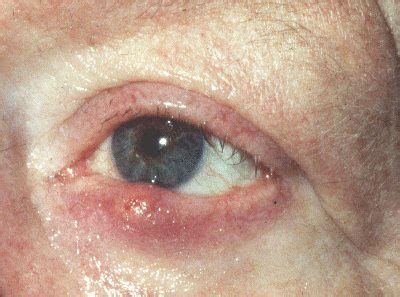 Abscess Defintion