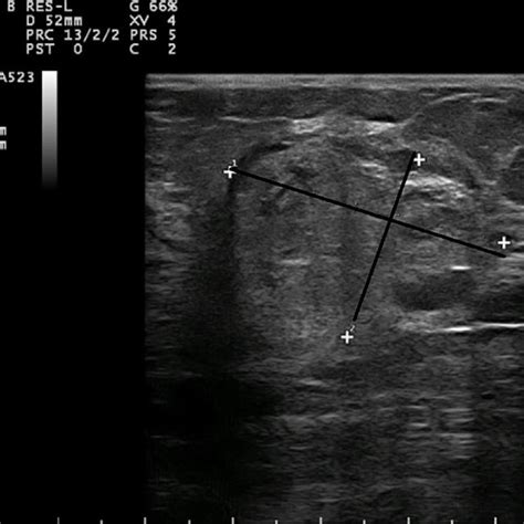 Ultrasound Of Benign Phyllodes Tumor In Left Breast Download
