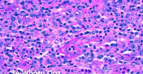 Histology Of Angioimmunoblastic T Cell Lymphoma Image