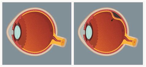 What To Expect During Recovery After A Retinal Detachment