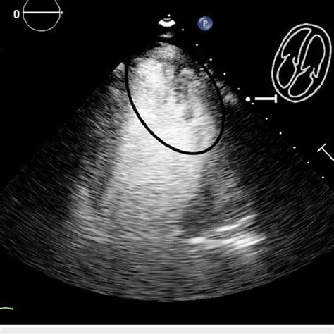 Perflutren Enhanced Images Demonstrating Heavy Trabeculation In The Download Scientific Diagram