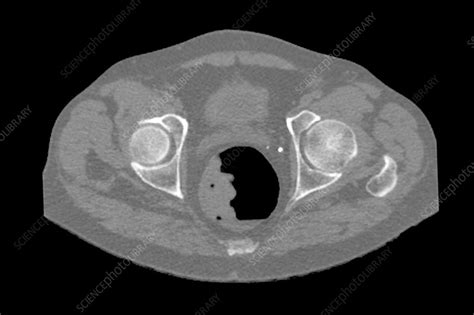 Cancer Of The Rectum Ct Scan Stock Image C007 1643 Science Photo Library