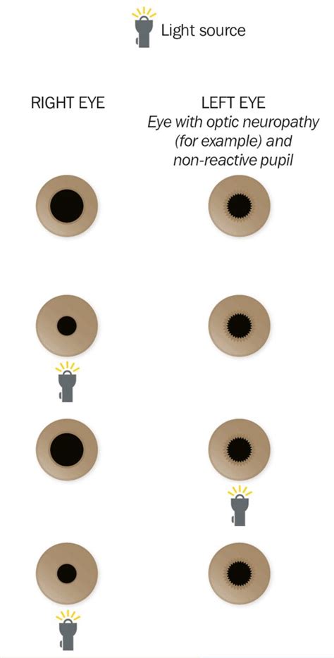 Pinpoint Pupils Size Mumugang