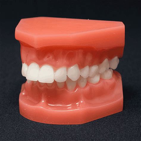 Orthodontic Typodont Class 2 Division 1 Excessive Overjetoverbite