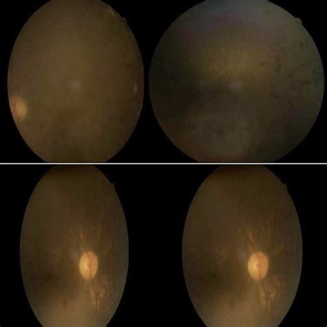 Fundoscopy Of Both Eyes Showing Bony Spicules Suggestive Of Retinitis
