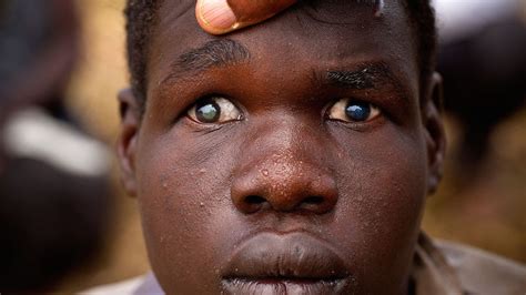 23 Million Nigerians Suffer From Eye Problems Expert Daily Post Nigeria