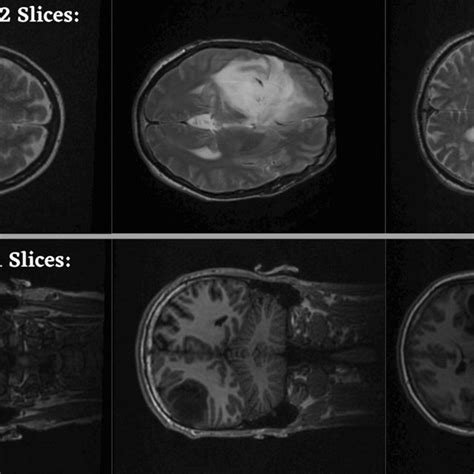 Diagram Of Sample Augmentation Result Of Mri Brain Tumor Images