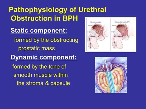 Benign Prostatic Hyperplasia Ppt