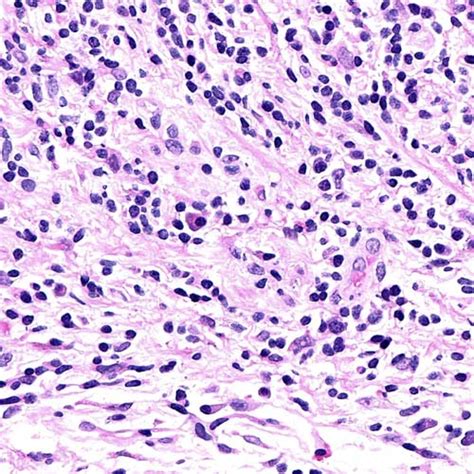 Autoimmune Igg4 Cholangitis Radiology Key