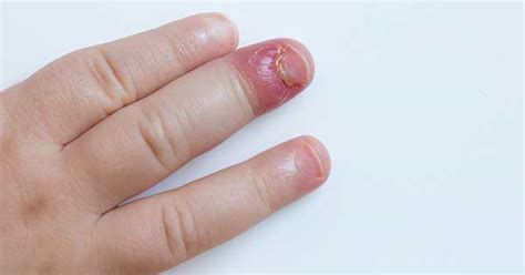 Tips Para Prevenir Una Infección De Dedo Durante El Confinamiento
