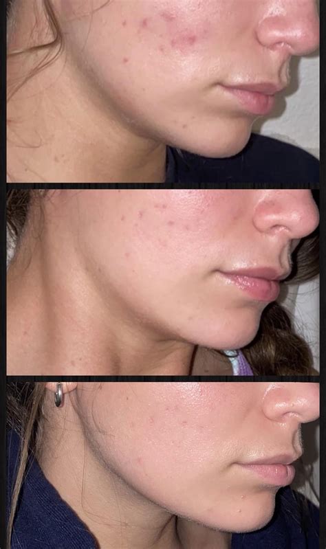 Doxycycline Fluconazole Rosacea Treatment R Rosacea