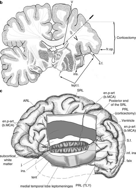 Hemispherectomy Neupsy Key