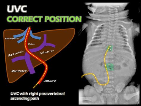 Umbilical Venous Catheter Uvc Is Recommended In Newborns Because The Vein Is Easily Identified