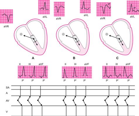 Av Nodal Junctional Rhythm