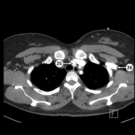 Brachiocephalic Artery Trunk