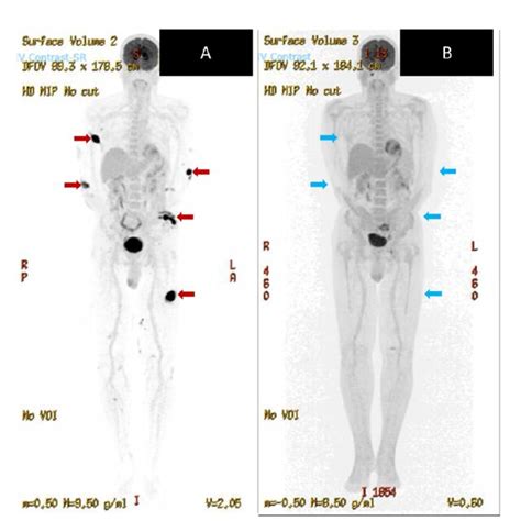 A Left Arm Nodules B Right Arm Nodule C Left Thigh Nodule