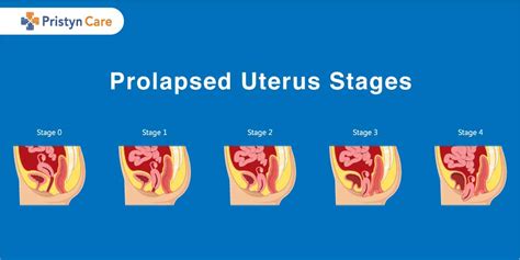 Pelvic Organ Prolapse Stages 566x234