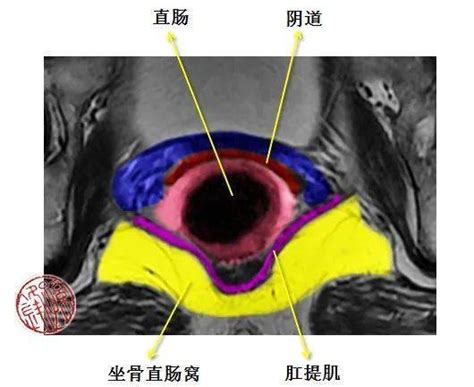 医学笔记︱一起读盆腔核磁共振：经女性股骨头韧带的横断层解剖