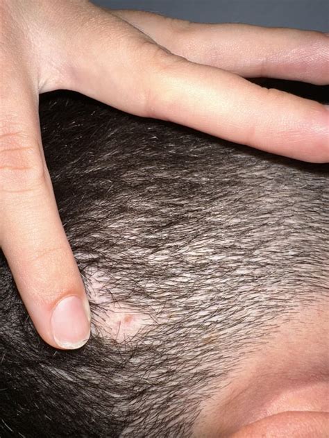 Bald Spot Rmalehairadvice