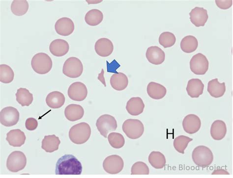 Schistocyte