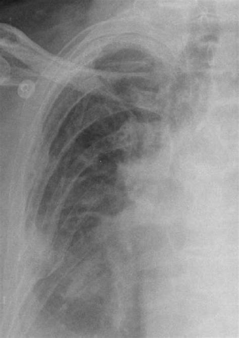 Chest X Ray Showing Interstitial Edema And Condensation At The Base Of Download Scientific