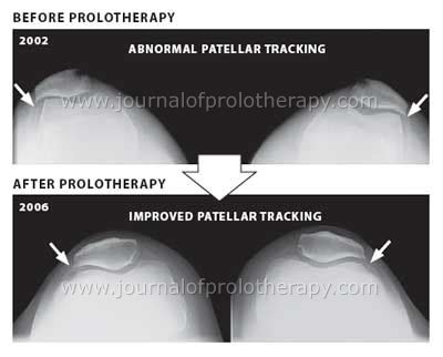 Prolotherapy Knee Cartilage Regeneration Standard Clinical X Ray