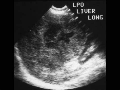 Mixed Echogenicity Finding The Common Vein