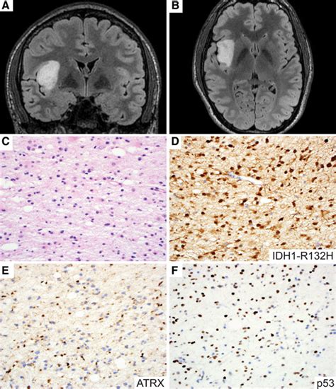 Example Of A Diffuse Astrocytoma Arising In The Cerebral Hemisphere Of