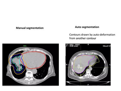 Three Dimensional Conformal Radiation Therapy Pptx 3 D Graphics