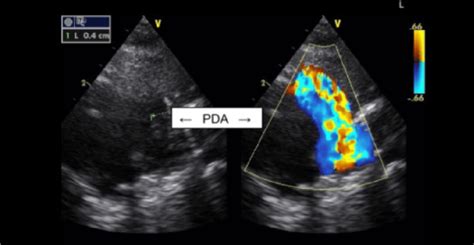 Transthoracic Echocardiogram Pda Patent Ductus Arteriosus Download