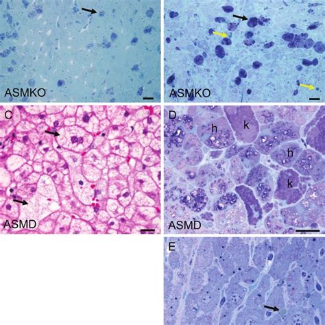 Pdf Optimization Of A Histopathological Biomarker For Sphingomyelin Accumulation In Acid