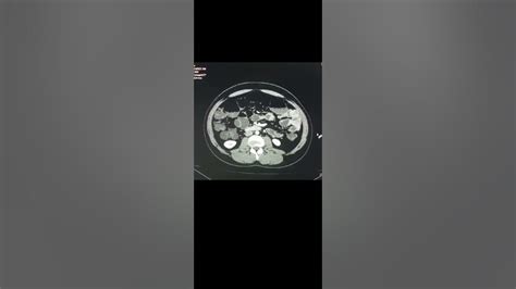 Ct Enterography Multiphasic Scan Computedtomography Youtube