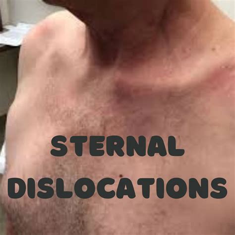 Sternal Dislocations 7 Shocking Facts And Risks
